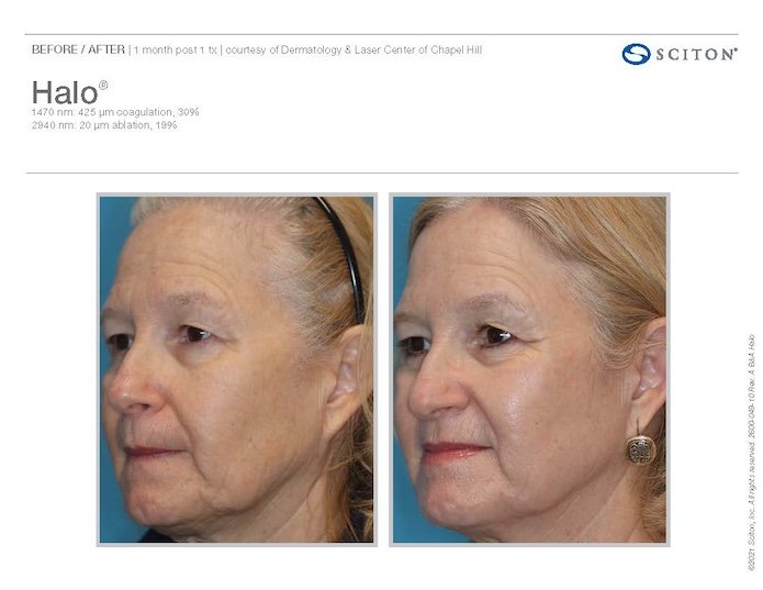 Sciton Halo™ Laser | Paul Pin, MD
